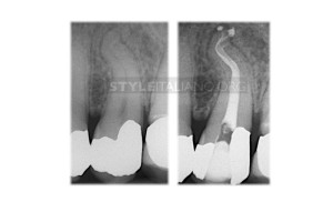 HOW TO MANAGE ROOTS DILACERATIONS - medicalkidunya