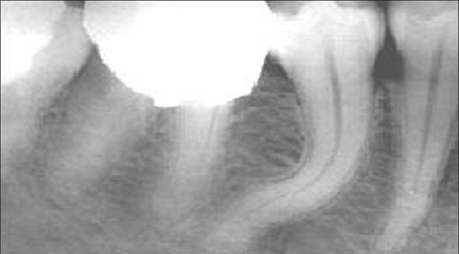 HOW TO MANAGE ROOTS DILACERATIONS - medicalkidunya