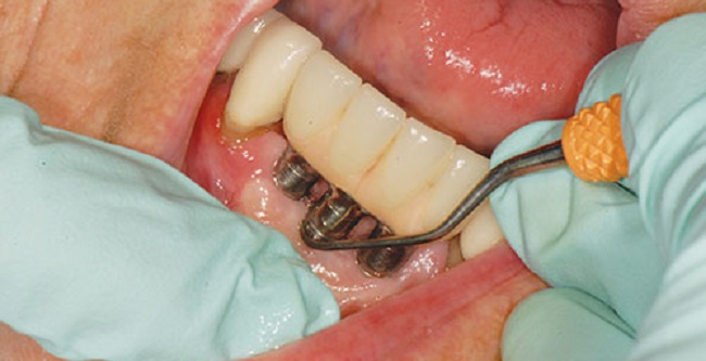 Choosing an Instrument for Implant Maintenance - medicalkidunya