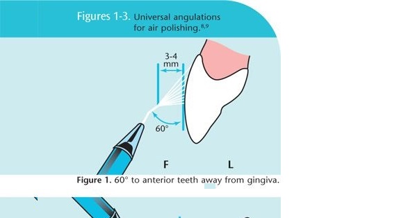 Universal Angulations for Air Polishing - medicalkidunya