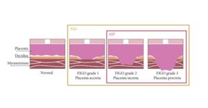 SPP and FIGO Grading Systems for Placenta Accreta Spectrum - medicalkidunya