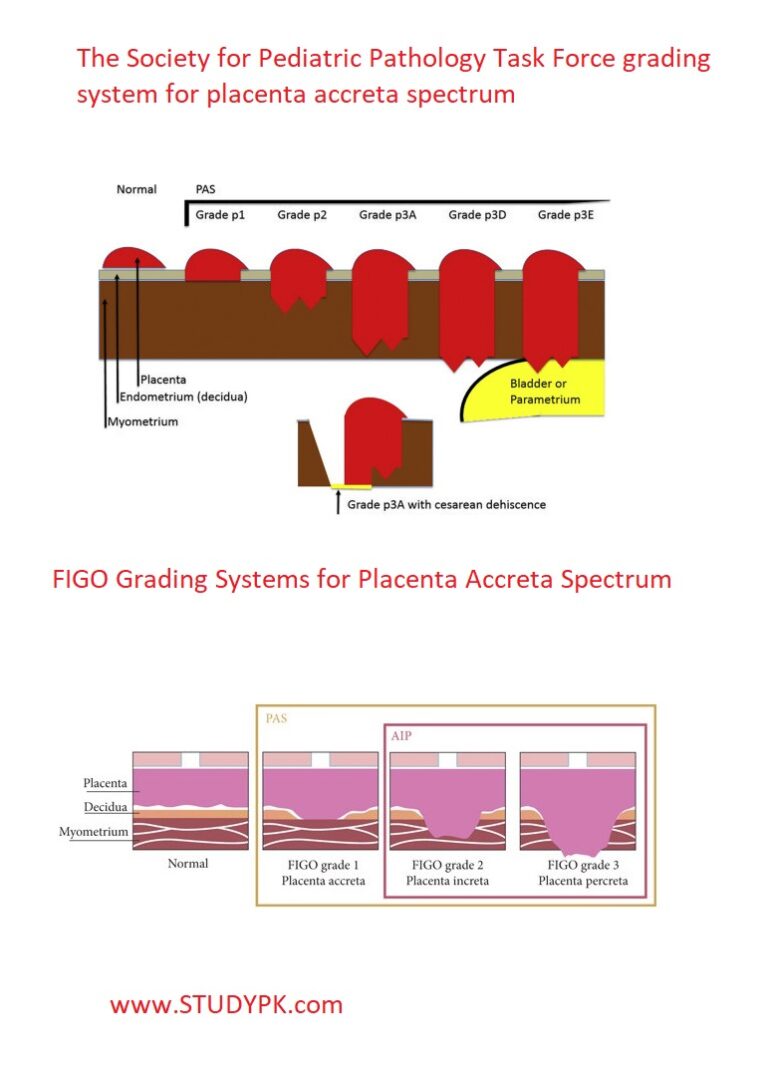 SPP and FIGO Grading Systems for Placenta Accreta Spectrum - medicalkidunya